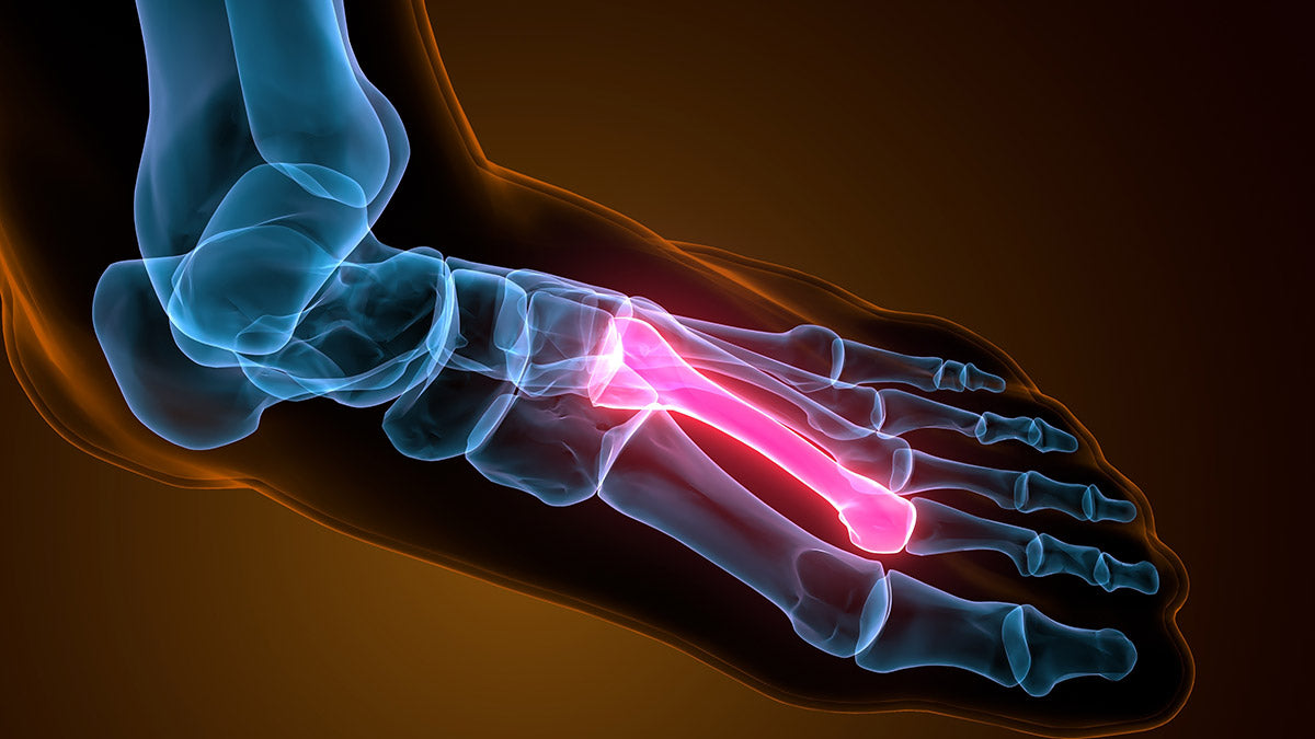 What You Need to Know About Second Metatarsal Fractures – GatsbyShoes
